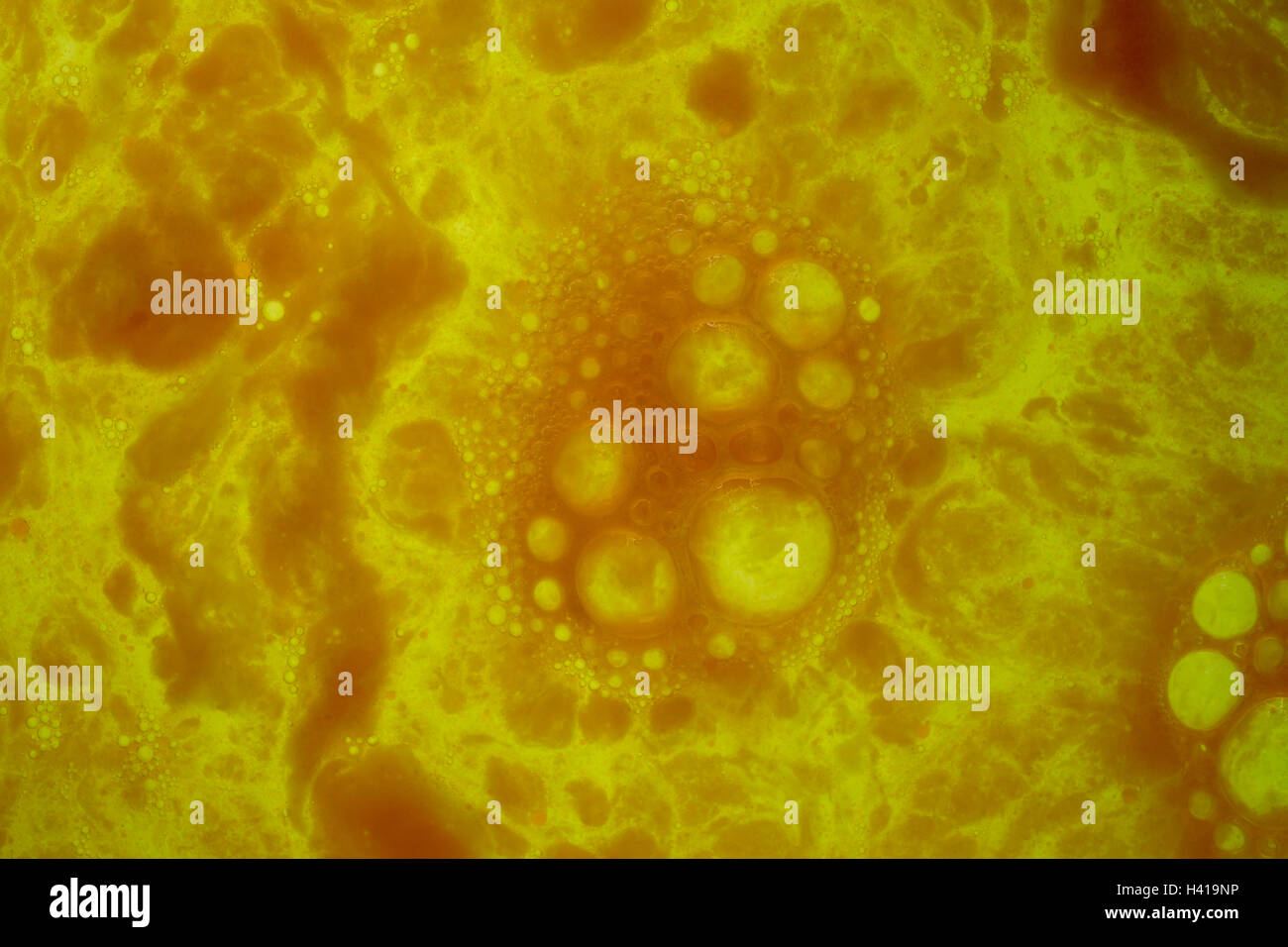 Fat Droplets In Urine