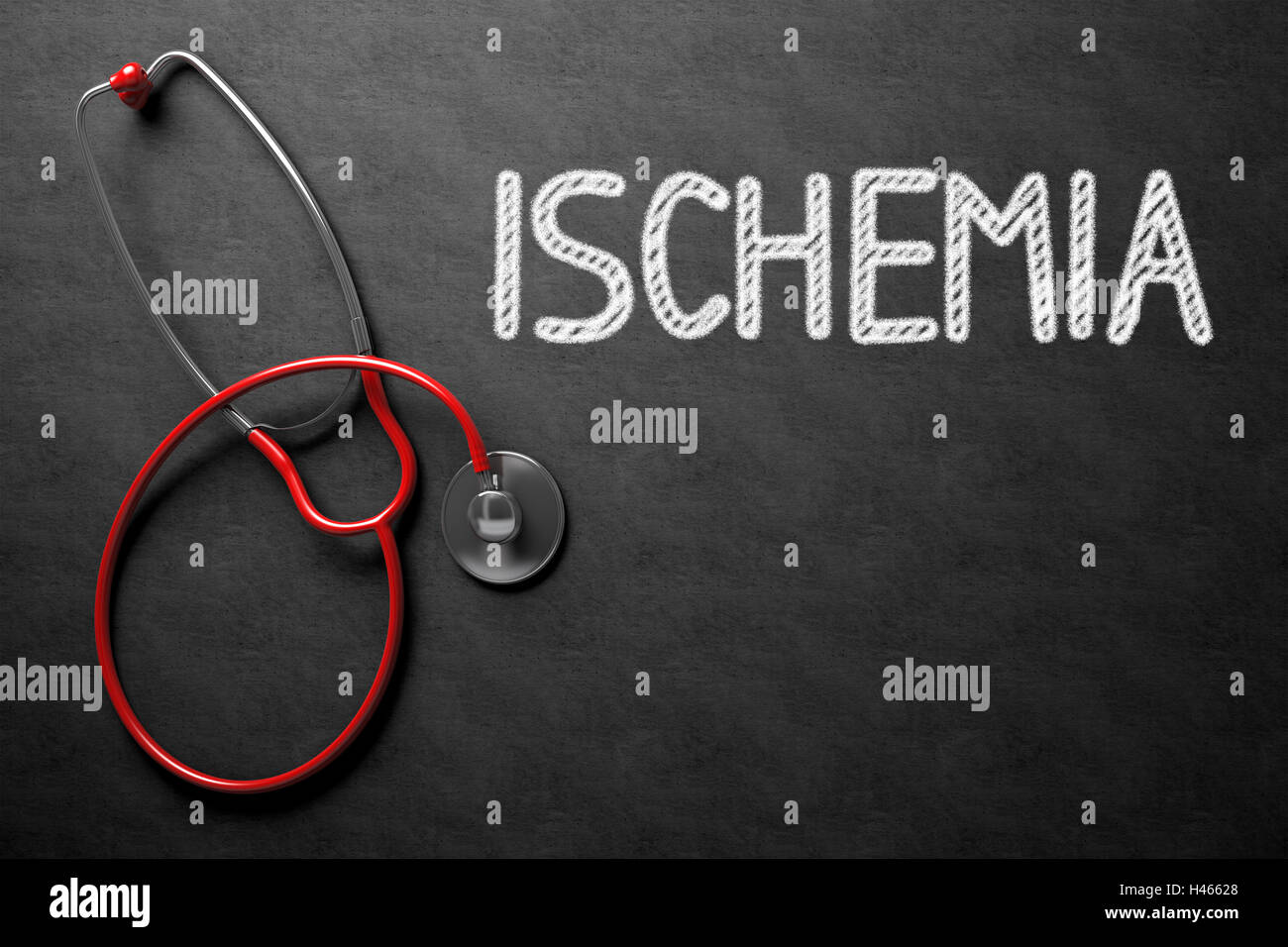 Ischemia hi-res stock photography and images - Alamy