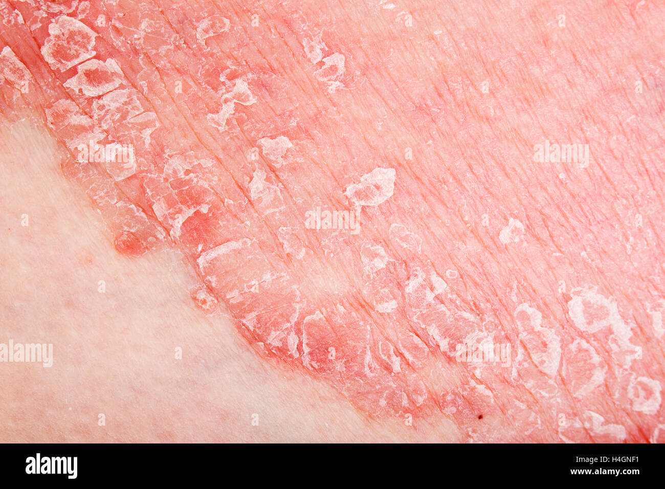 Dry Scaly Skin High Resolution Stock Photography and Images - Alamy