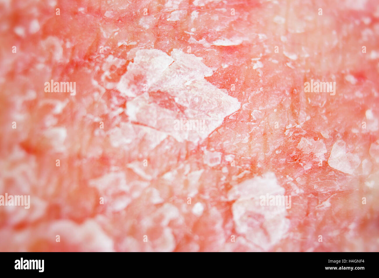 Dry Scaly Skin High Resolution Stock Photography and Images - Alamy