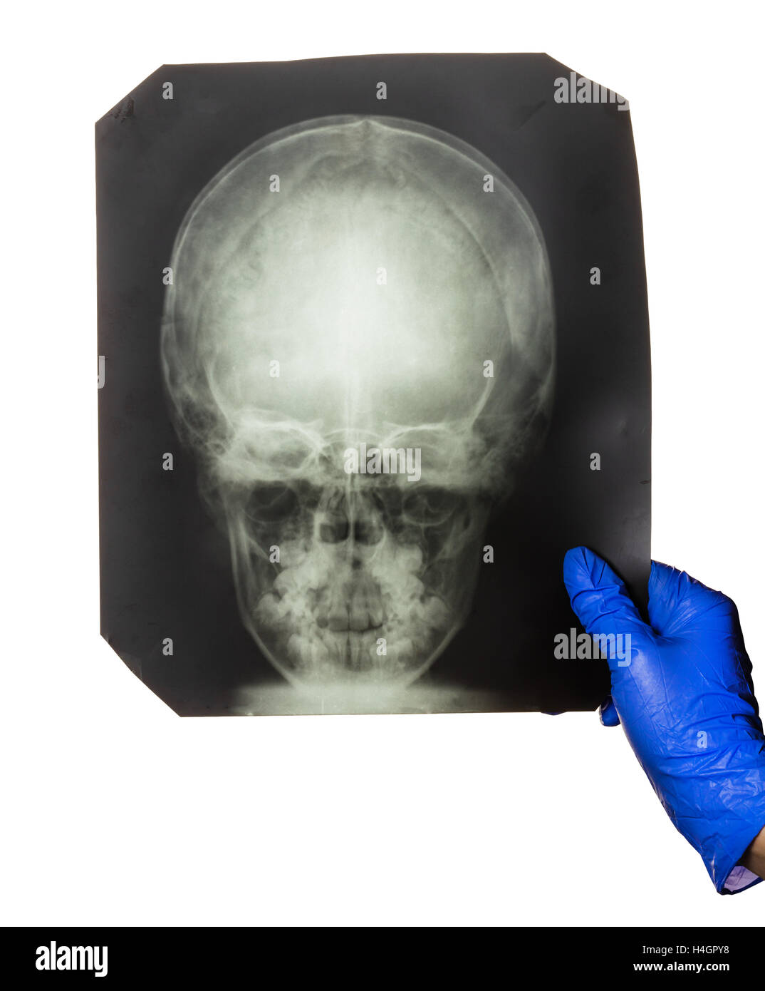 Medical radiograph hi-res stock photography and images - Alamy