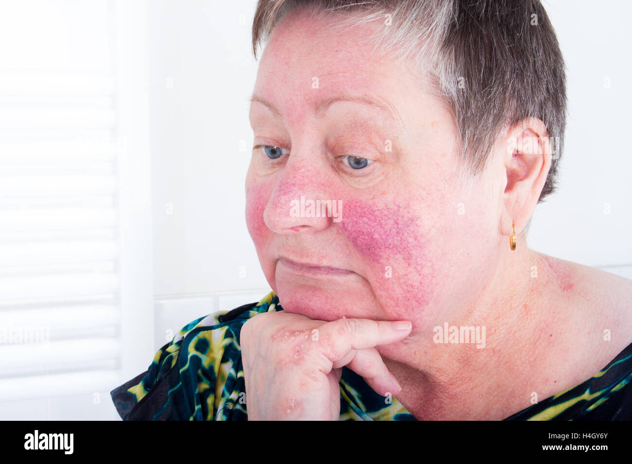 Disease Rosacea High Resolution Stock Photography and Images - Alamy