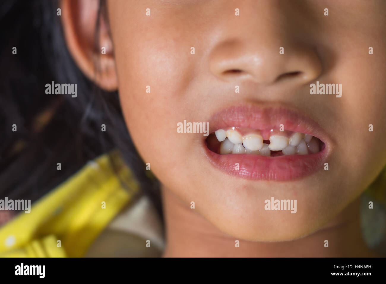 Rotten teeth child hi-res stock photography and images - Alamy