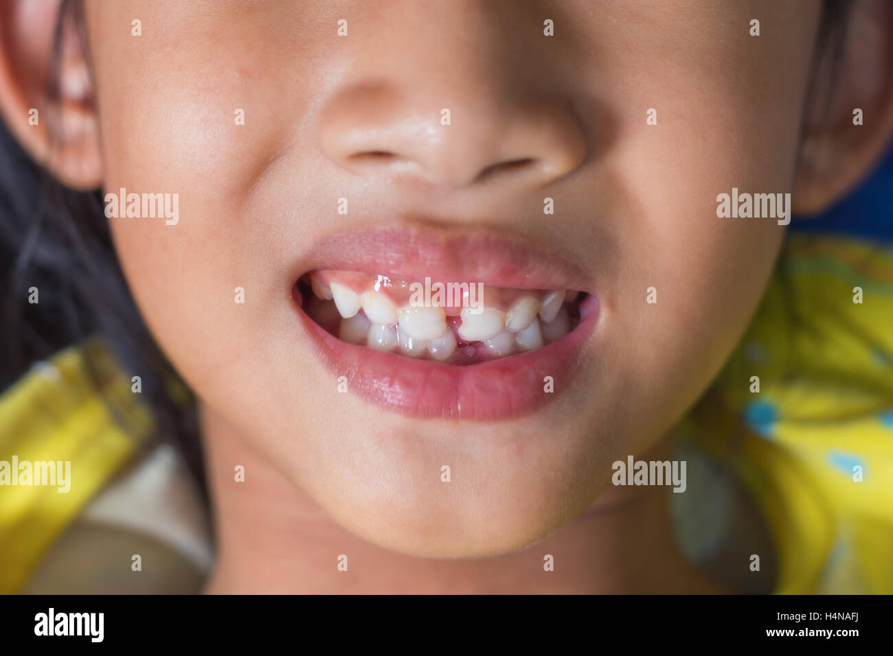 Rotten teeth child hi-res stock photography and images - Alamy