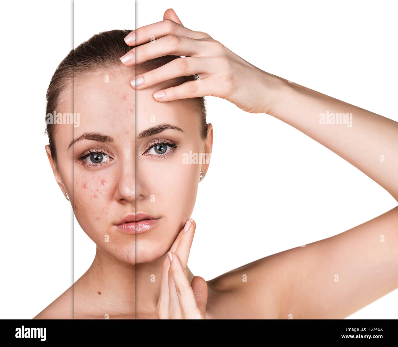 Woman with problem skin Stock Photo - Alamy