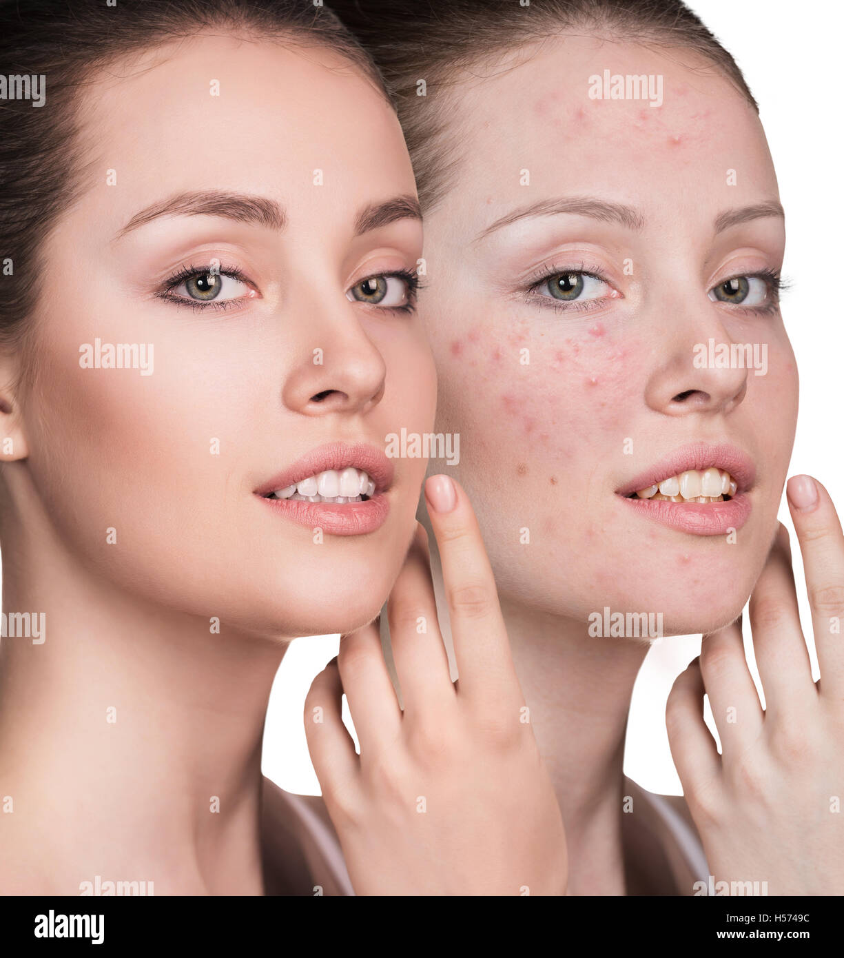 Woman with problem skin on her face Stock Photo - Alamy