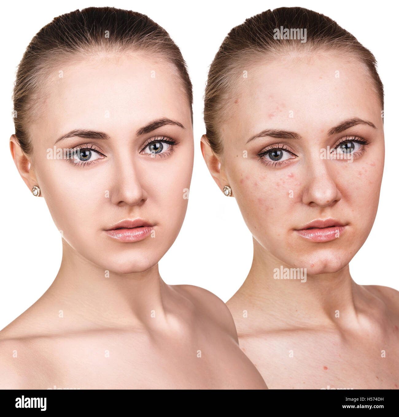 Acne problem hi-res stock photography and images - Alamy