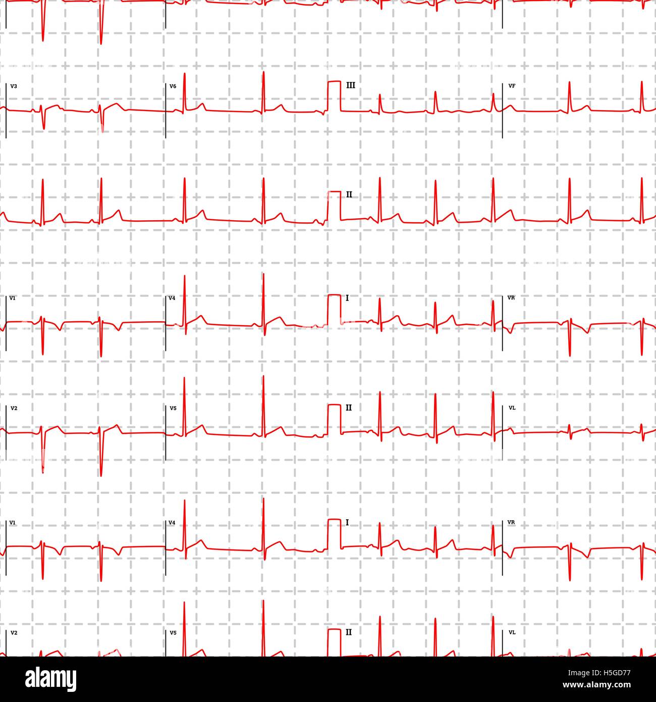 Electrocardiogram red graph with marks on white, seamless pattern Stock ...