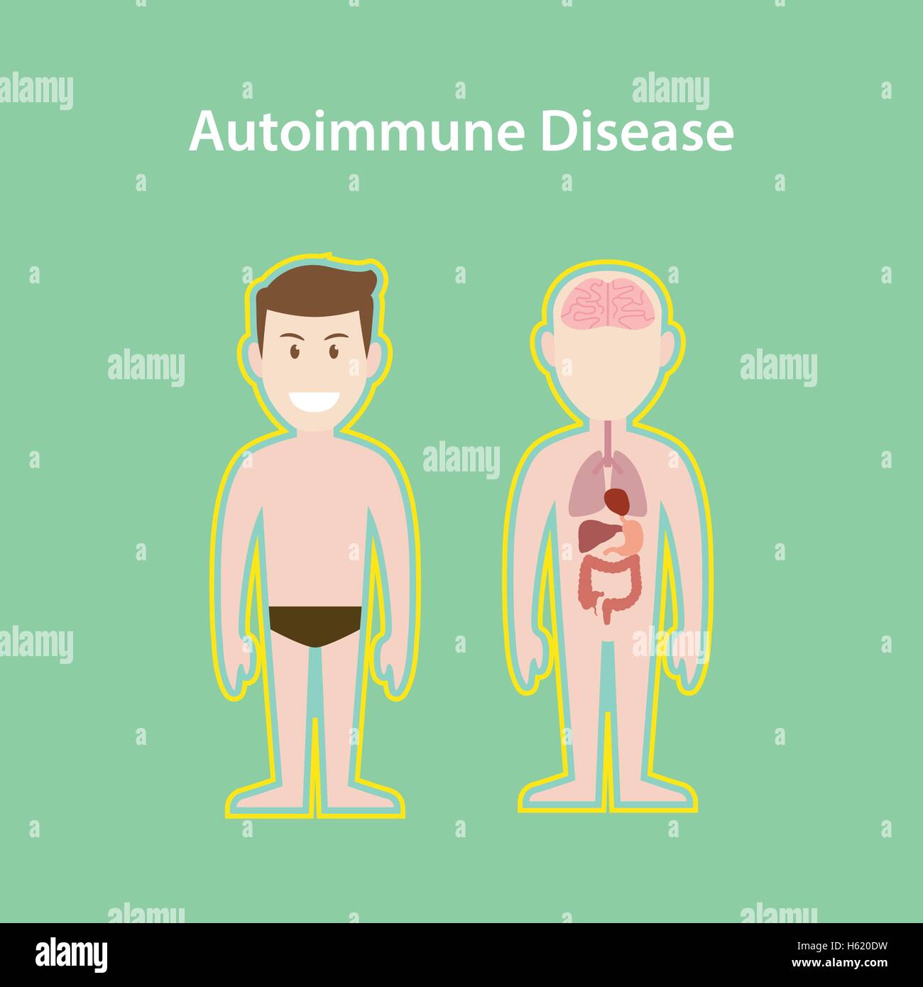 autoimmune disease system illustration with cartoon human man body ...