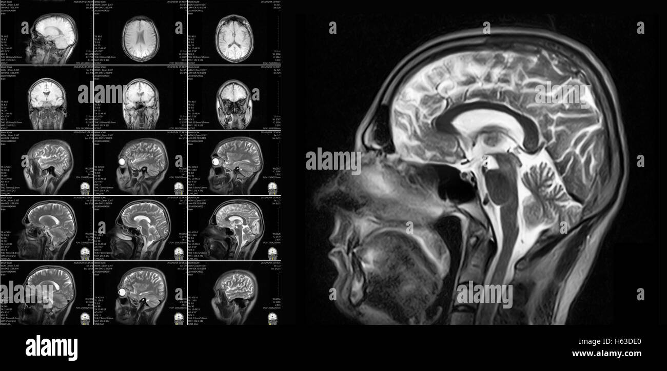 Brain neurons ct scan hi-res stock photography and images - Alamy