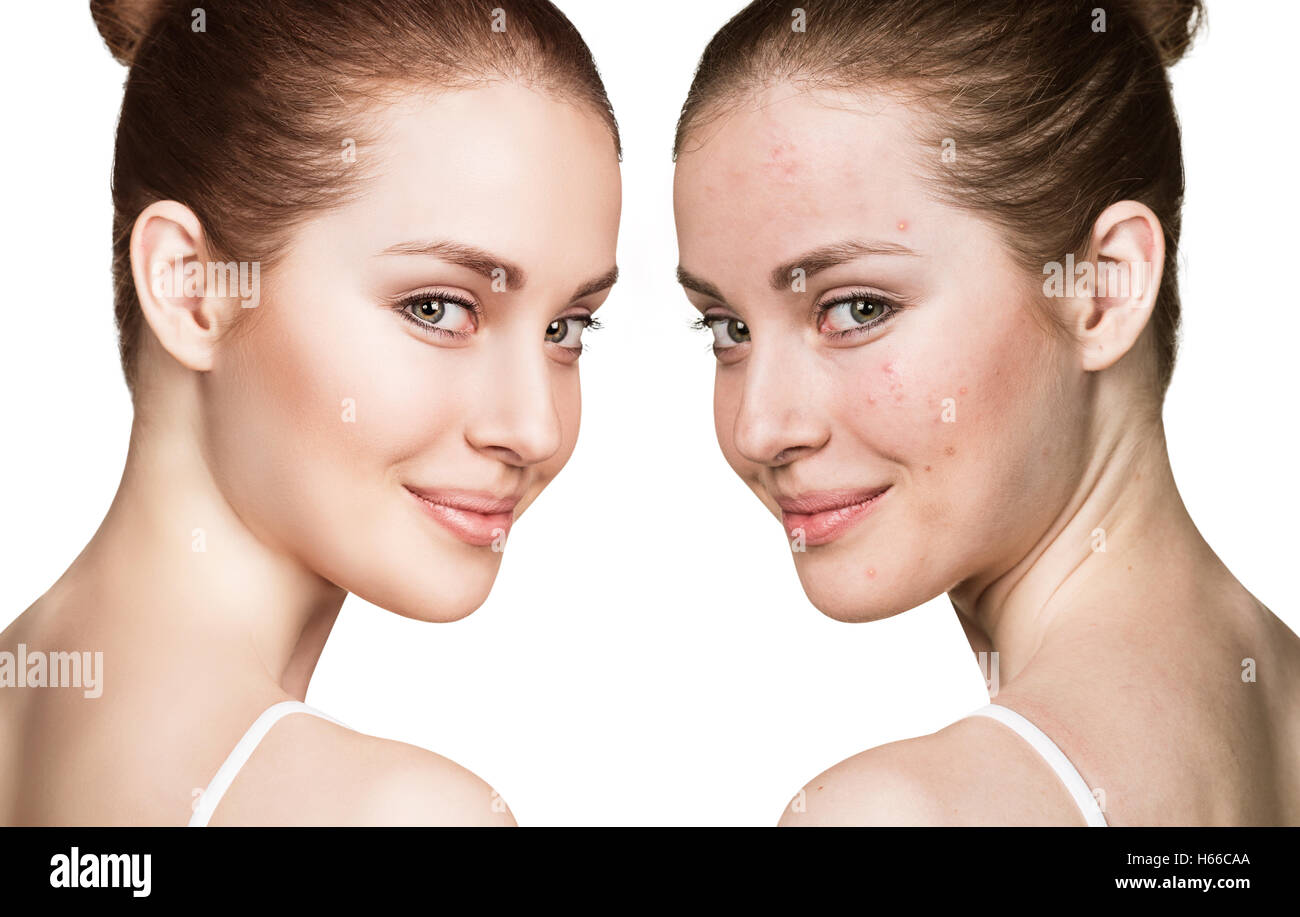 Comparison portrait of young girl with problematic skin before and ...