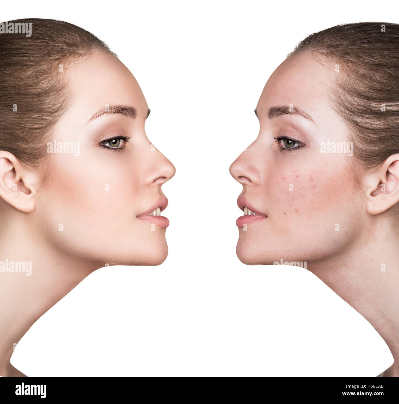 Comparison portrait of young girl with problematic skin before and ...