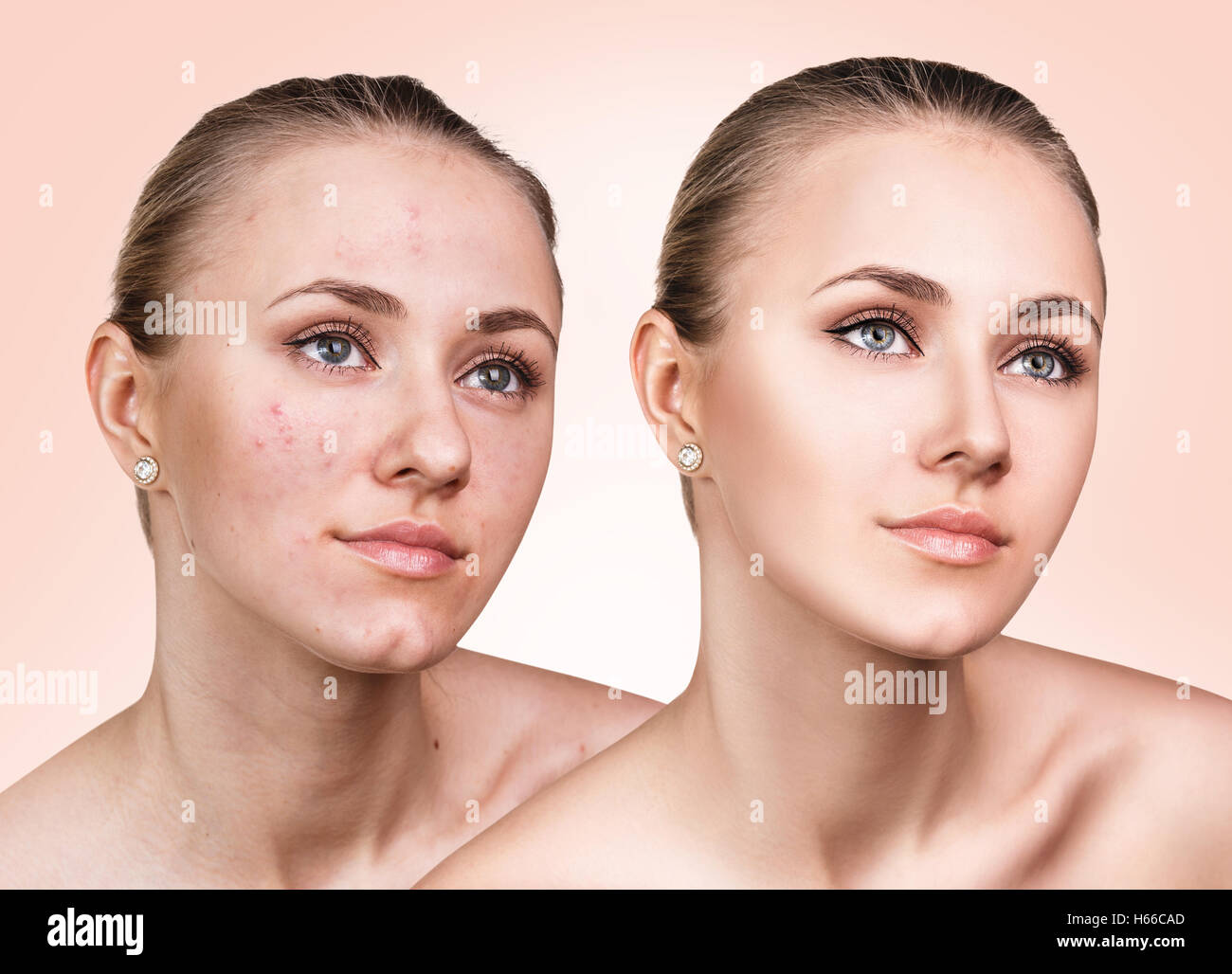 Comparison portrait of young girl with problematic skin before and ...