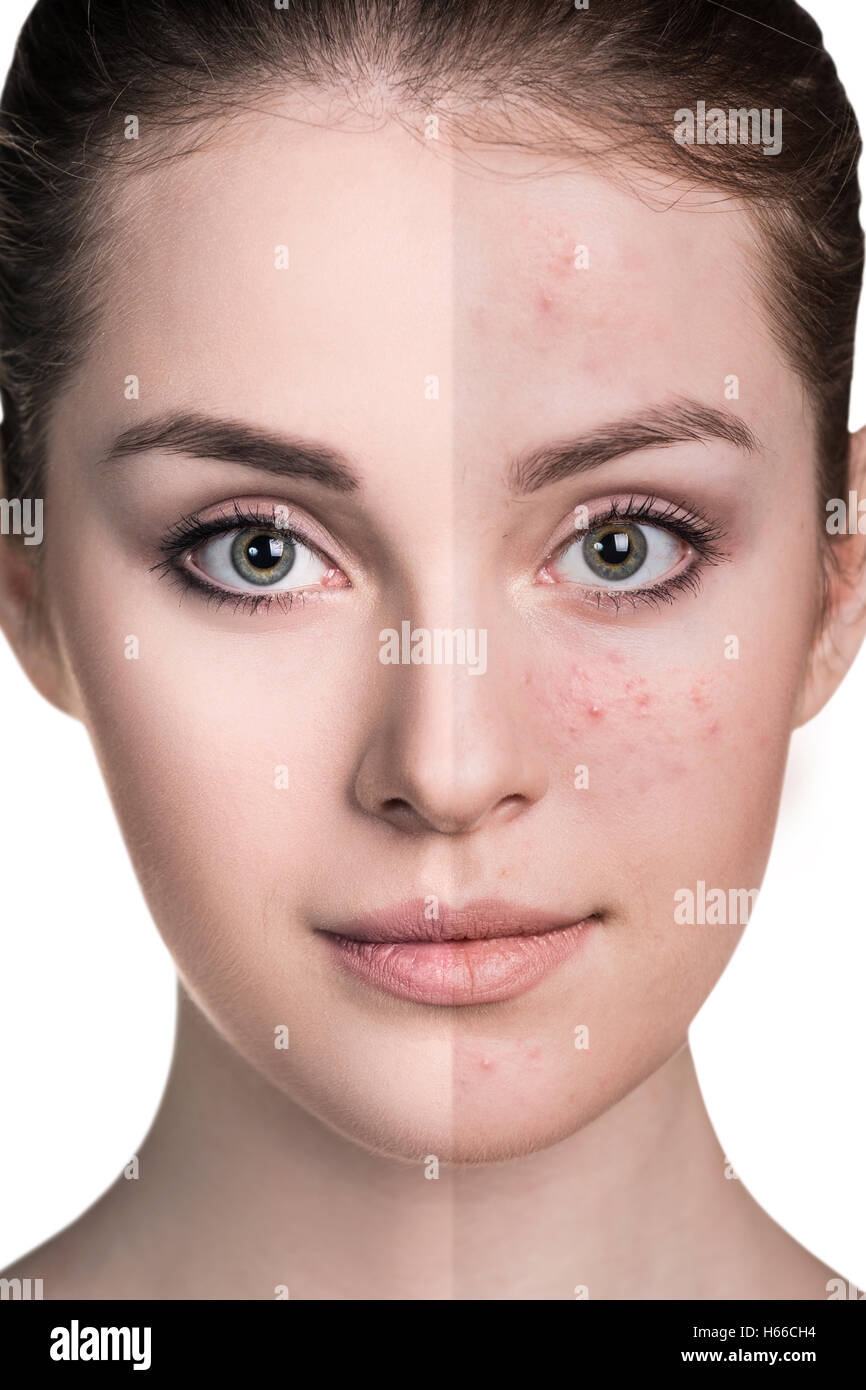 Woman with problem skin on her face before and after treatment over ...