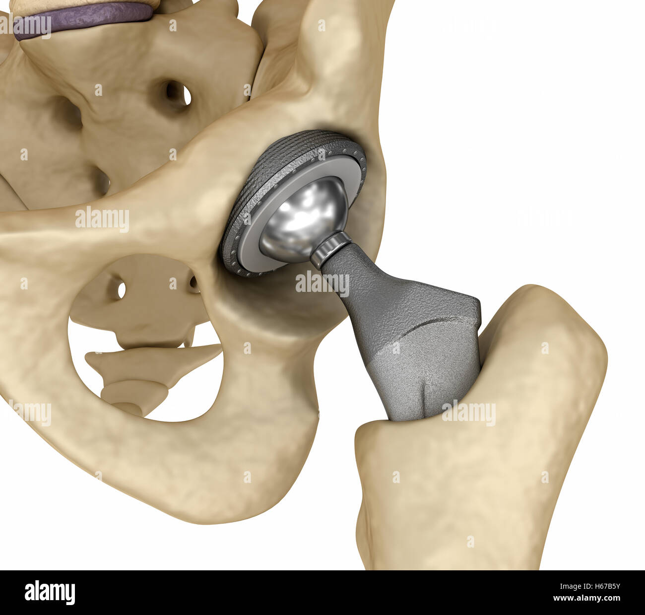 Hip replacement implant installed in the pelvis bone. Medically ...