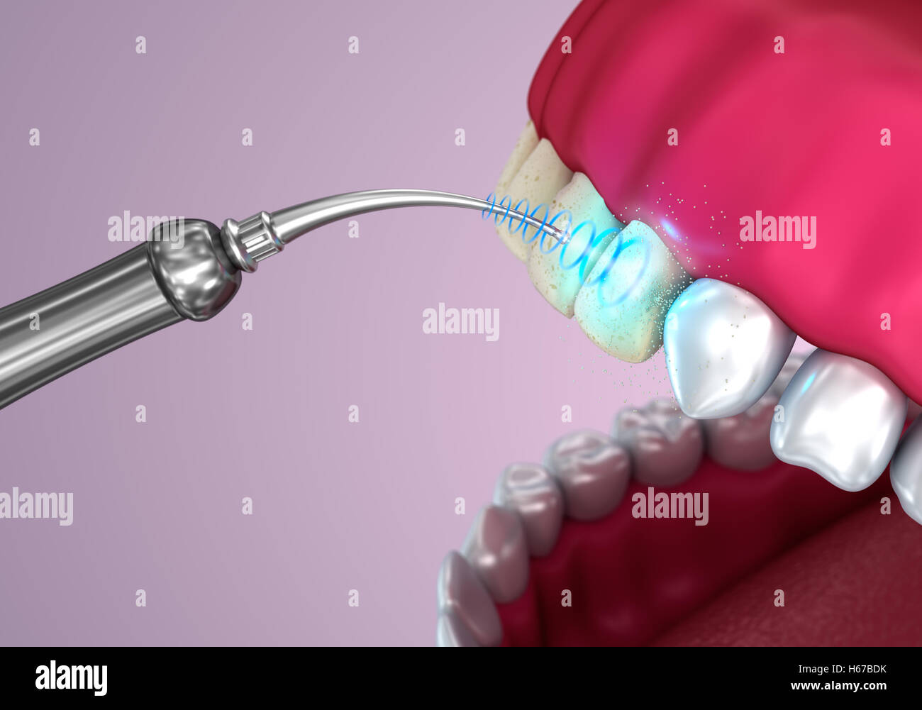 Teeth whitening , Medically accurate 3D illustration Stock Photo - Alamy
