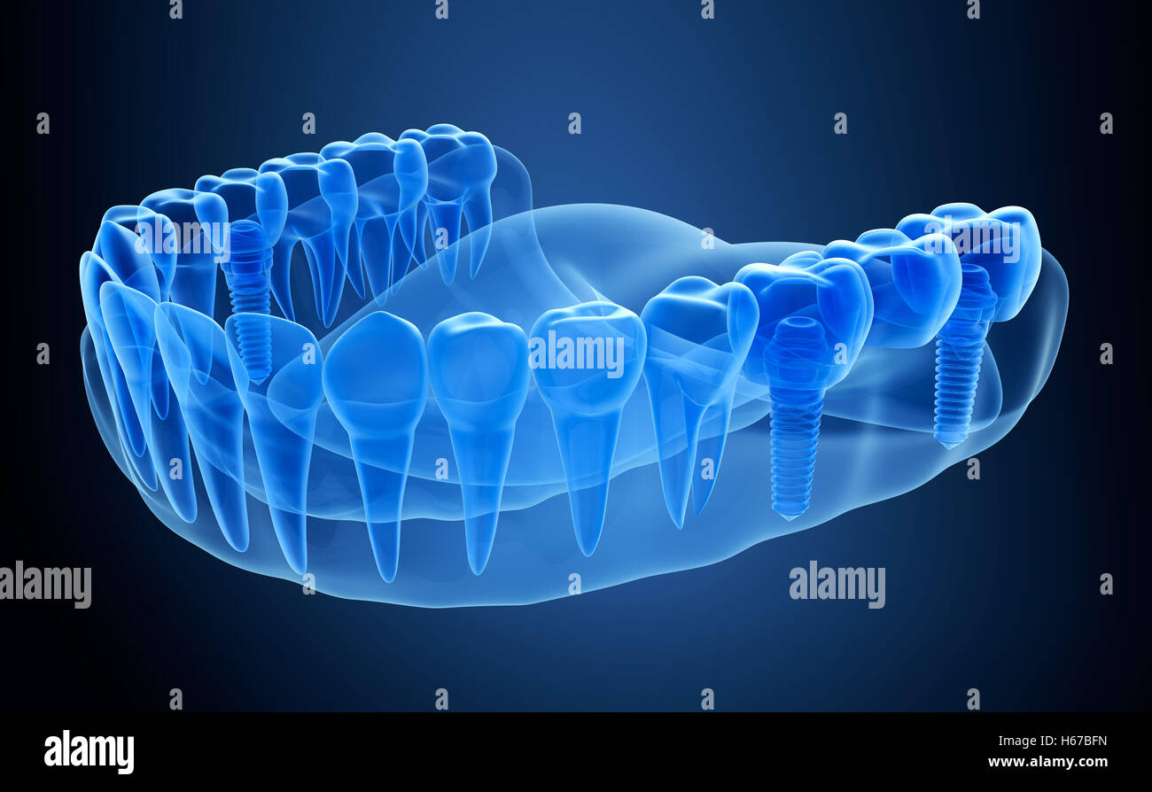 X-ray view of denture with implant. Xray view. Medically accurate 3D ...