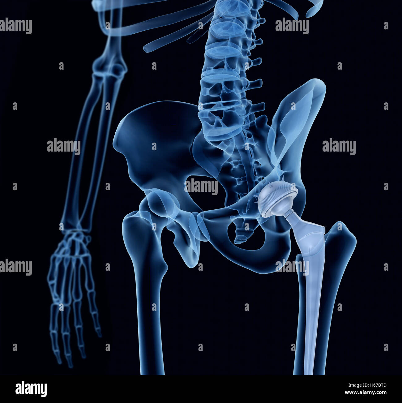 Hip replacement implant installed in the pelvis bone. X-ray view ...