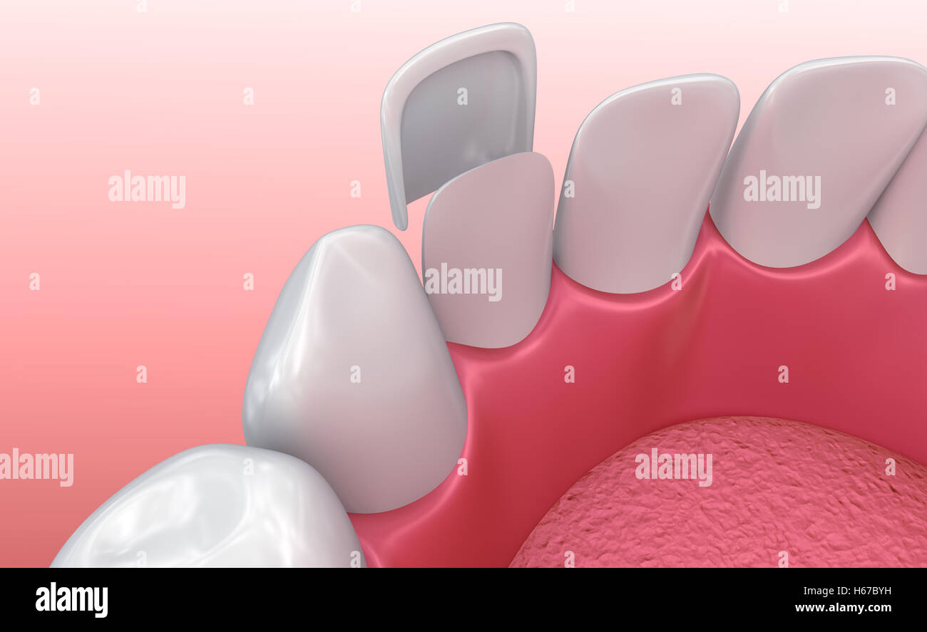 Dental Veneers: Porcelain Veneer installation Procedure. 3D ...