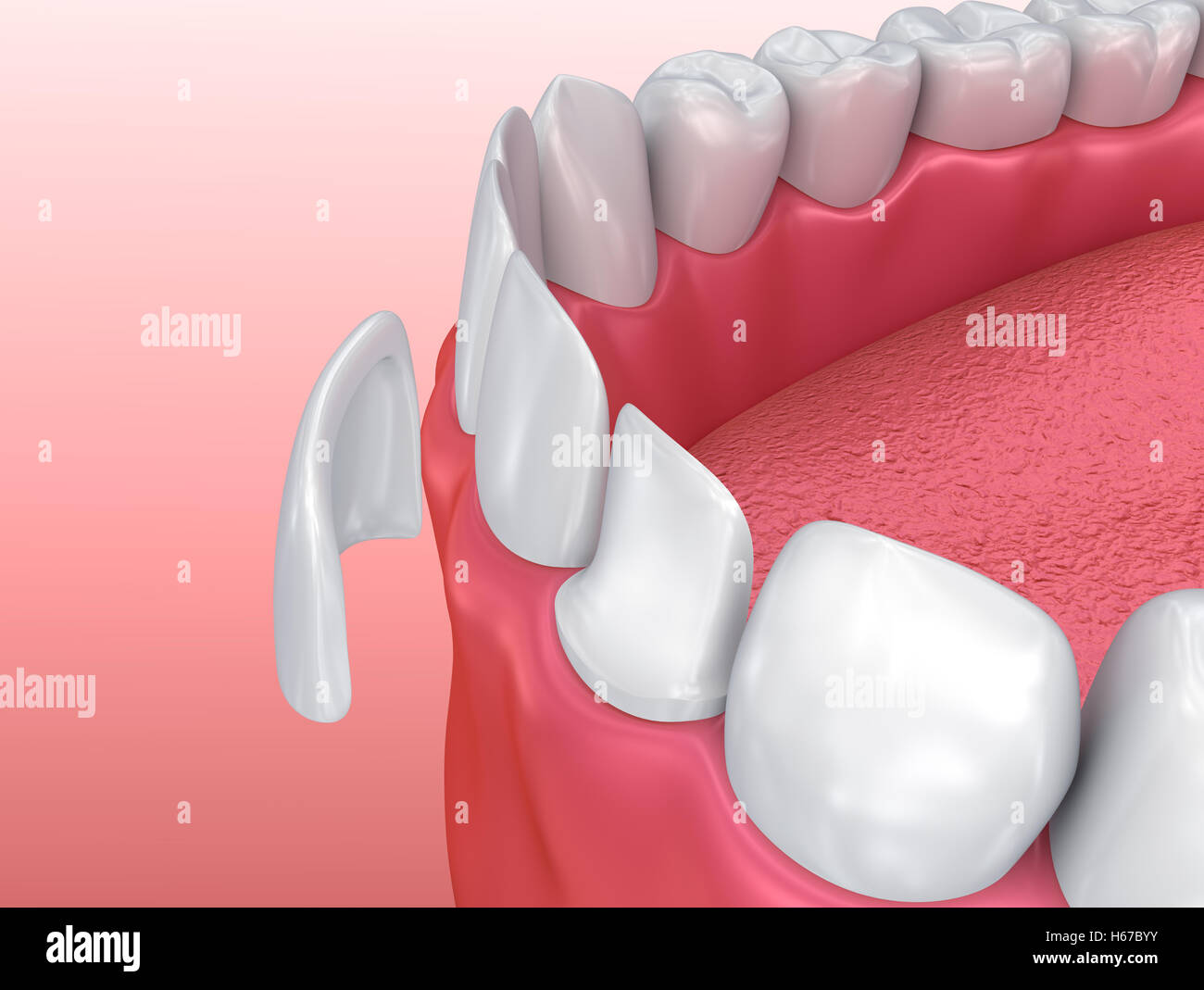 Dental Veneers: Porcelain Veneer installation Procedure. 3D ...