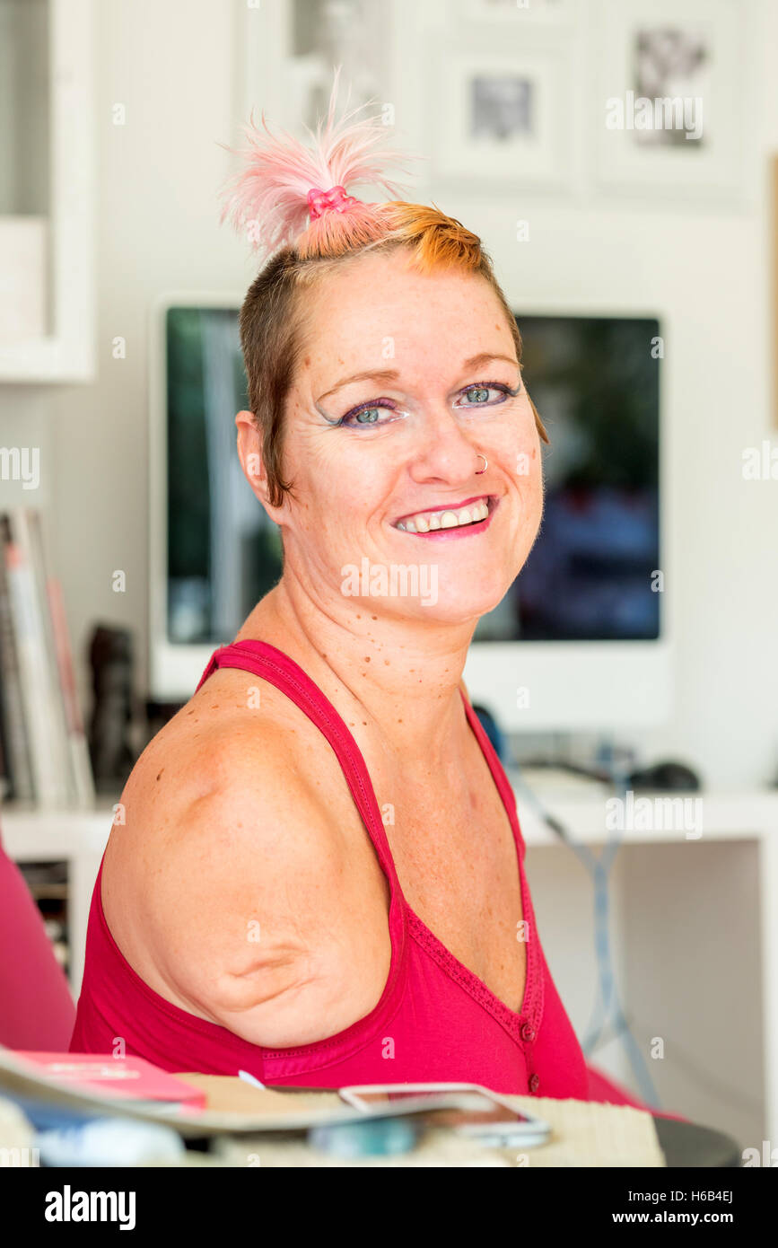 Phocomelia hi-res stock photography and images - Alamy