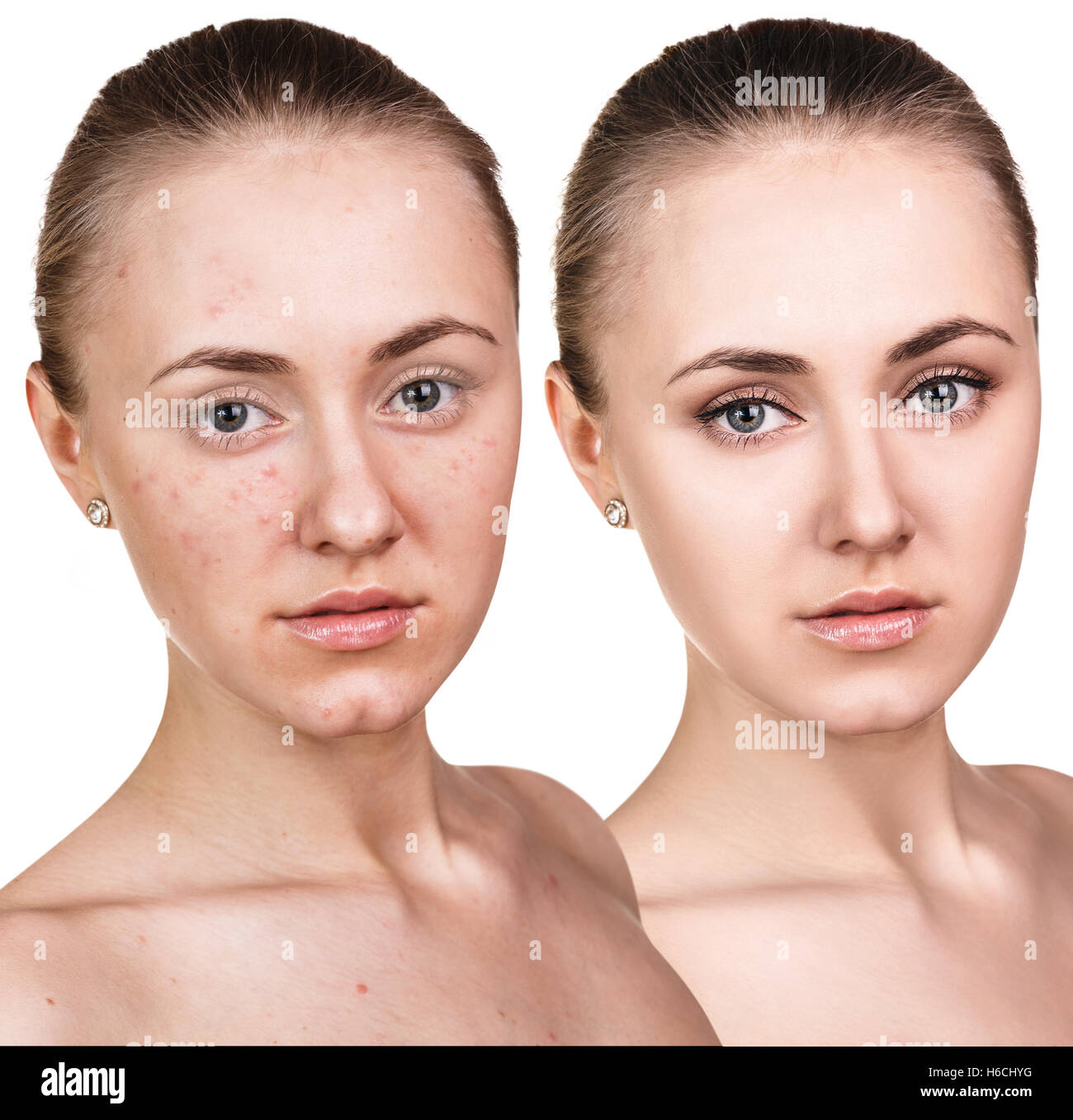 Woman with problem skin on her face Stock Photo - Alamy