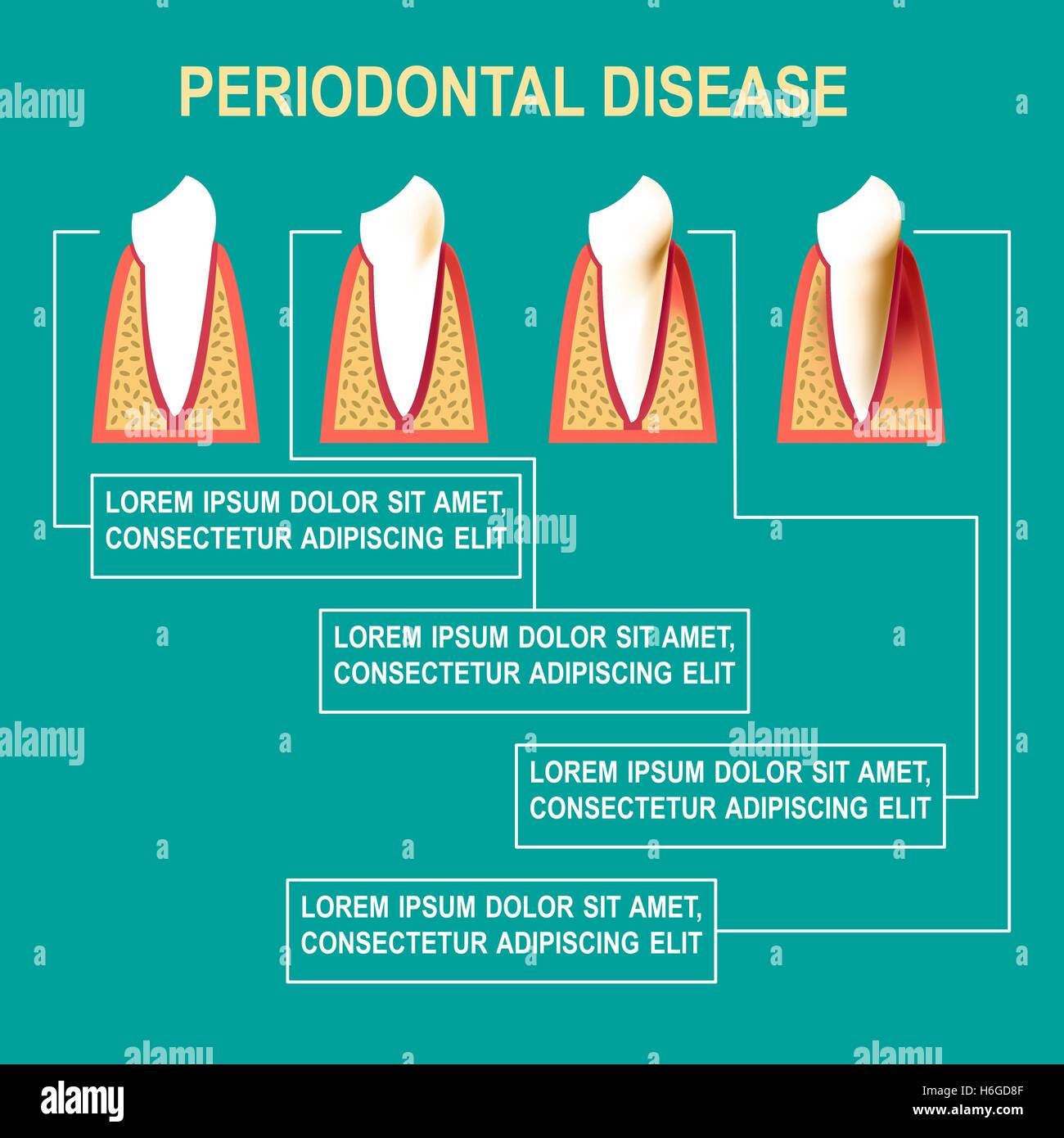 Periodontal hi-res stock photography and images - Alamy