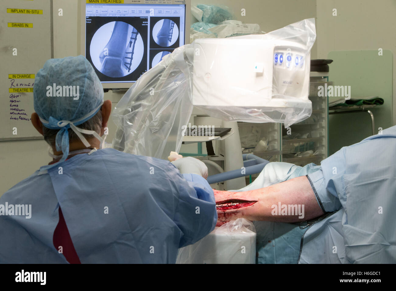 Open Reduction And Internal Fixation Of Ankle Ankle Operation Stock