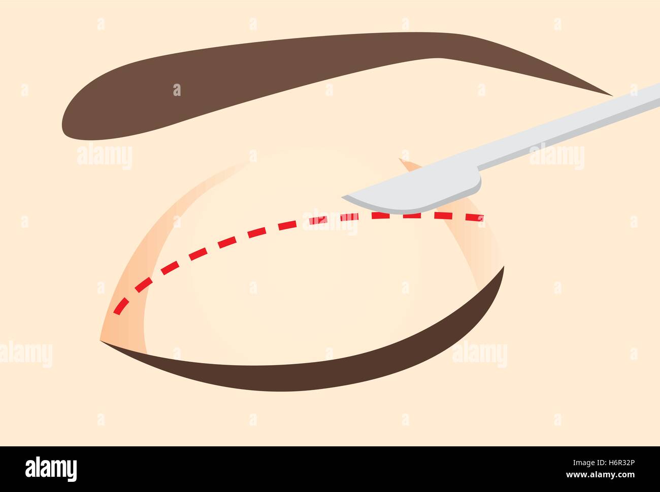 Raised swelling Stock Vector Images - Alamy