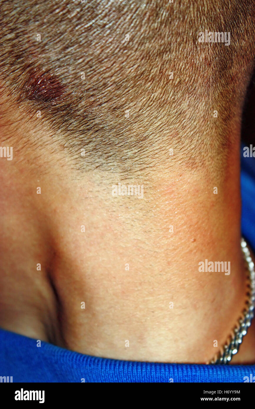 Scab on the hair of a man, a bacterial infection Stock Photo - Alamy