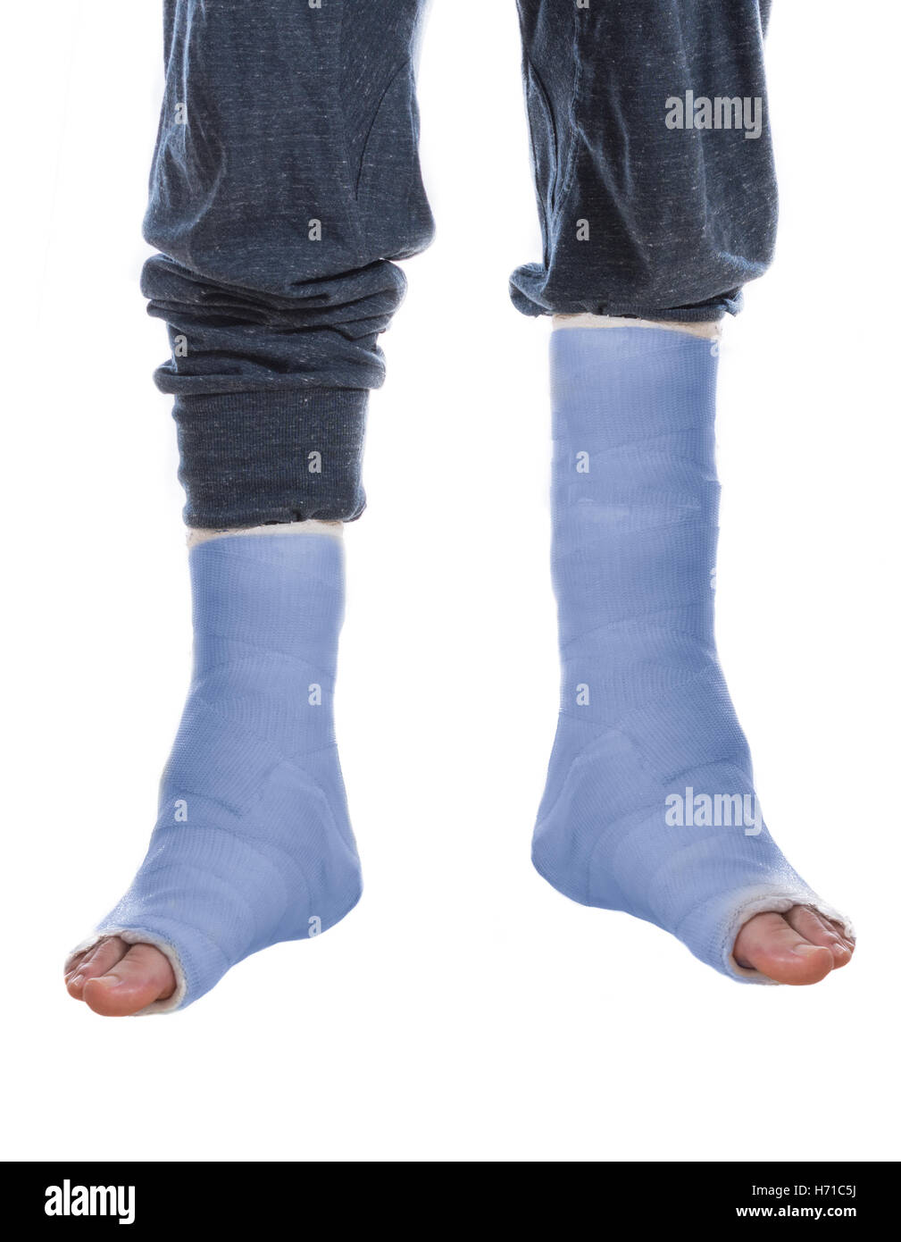 Plaster Leg Cast Legs Stock Photos & Plaster Leg Cast Legs Stock Images ...