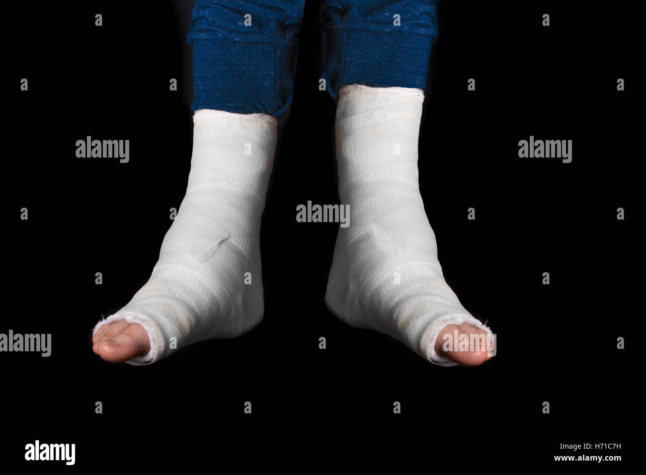 Young man with two broken ankles and dual white casts on his legs ...
