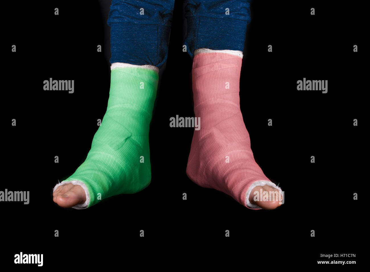 Plaster leg cast legs hi-res stock photography and images - Alamy