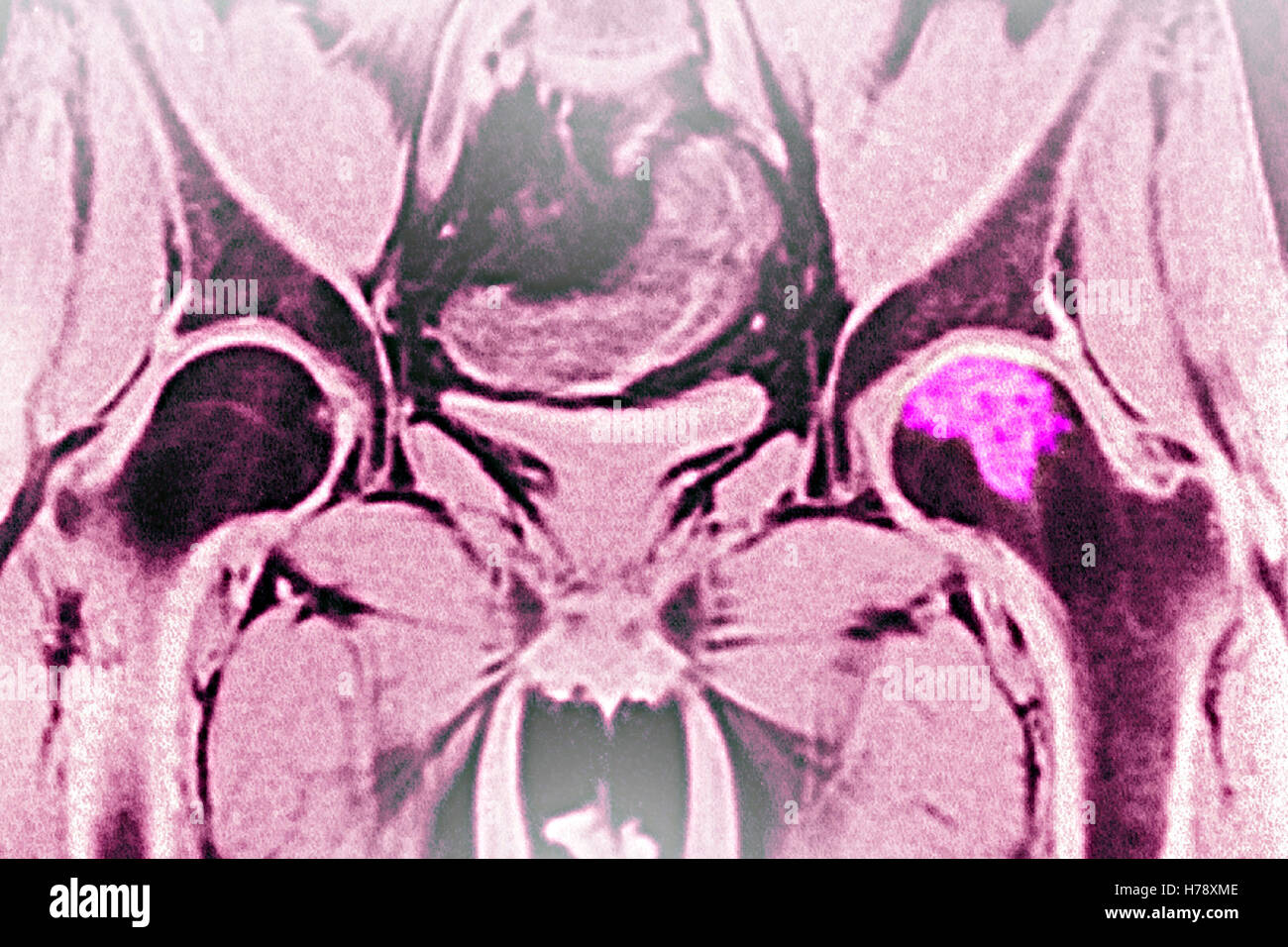 HIP OSTEOARTHRITIS, MRI Stock Photo - Alamy HIP OSTEOARTHRITIS, MRI Stock Photo - Alamy