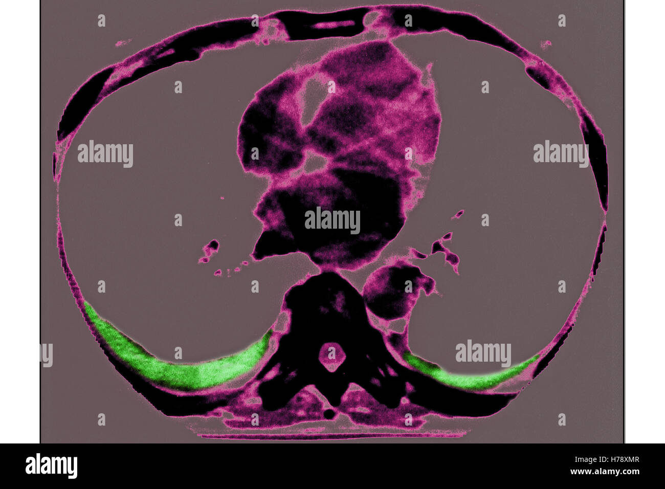 Pulmonary fibrosis ct scan hi-res stock photography and images - Alamy