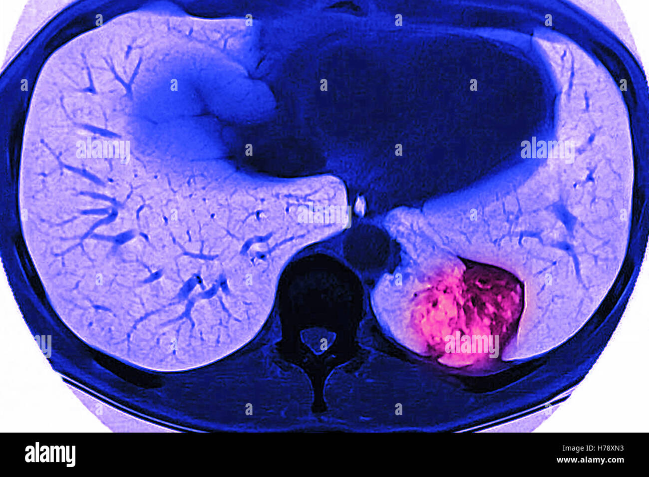 Tumor Mri Stock Photos & Tumor Mri Stock Images - Alamy