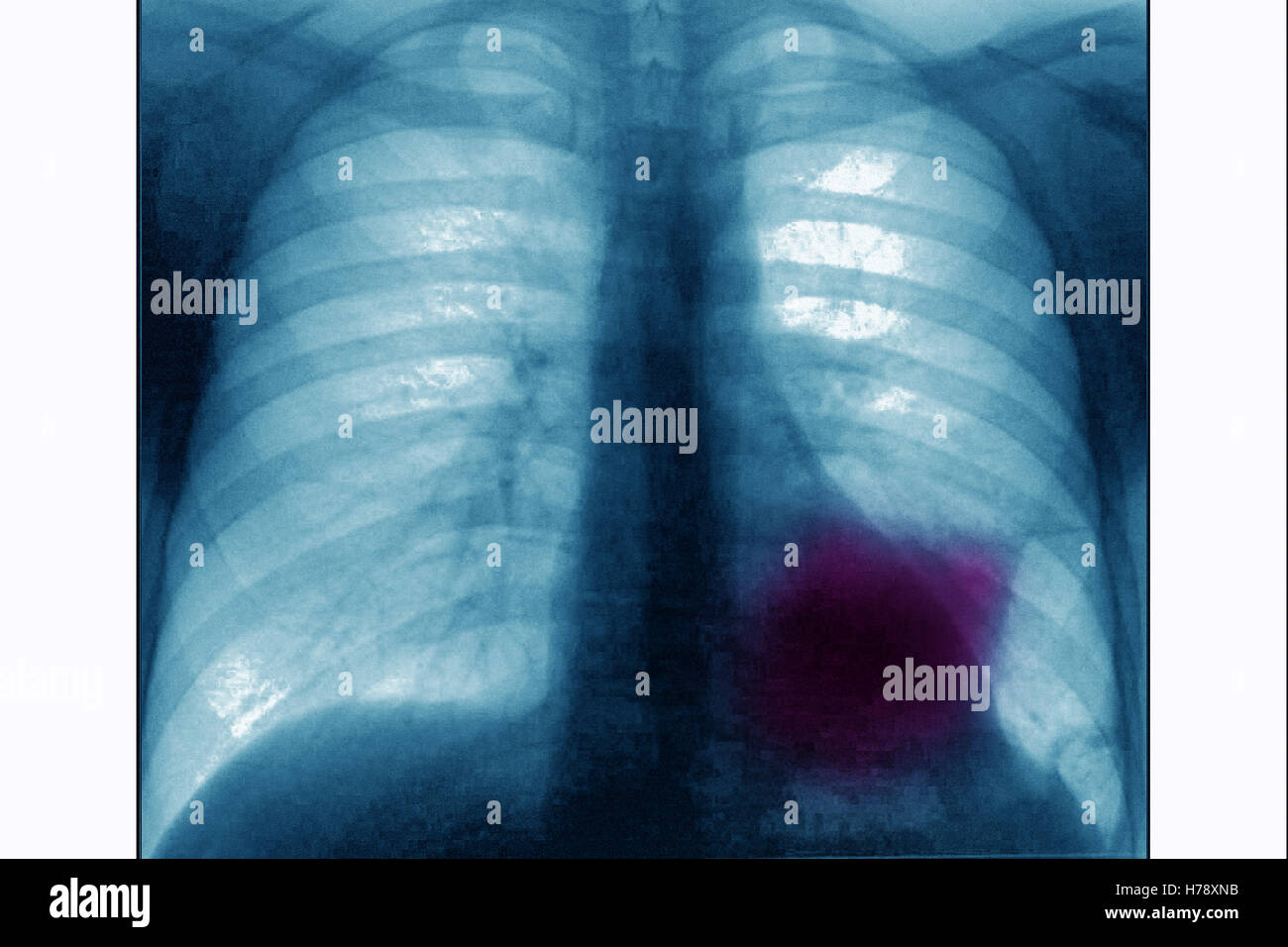LUNG CANCER, X-RAY Stock Photo - Alamy