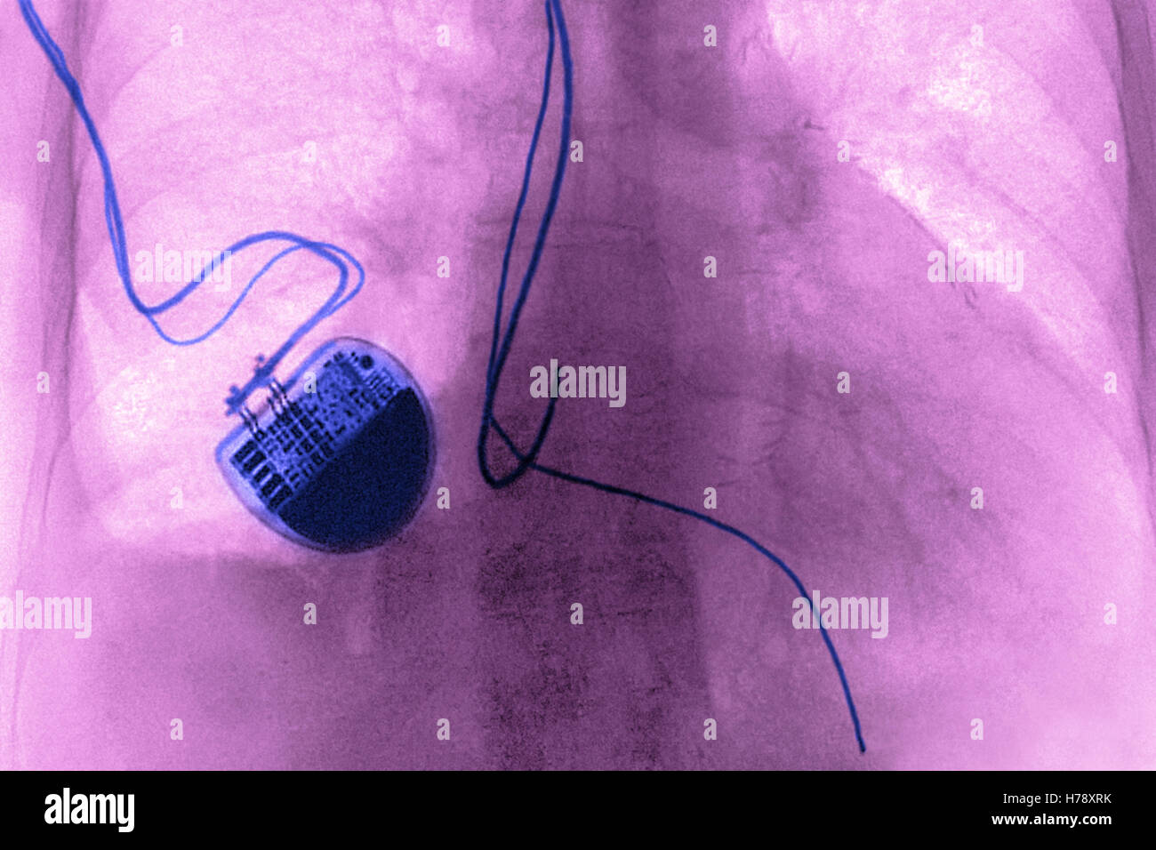Cardiac Pacemaker Stock Photos & Cardiac Pacemaker Stock Images - Alamy