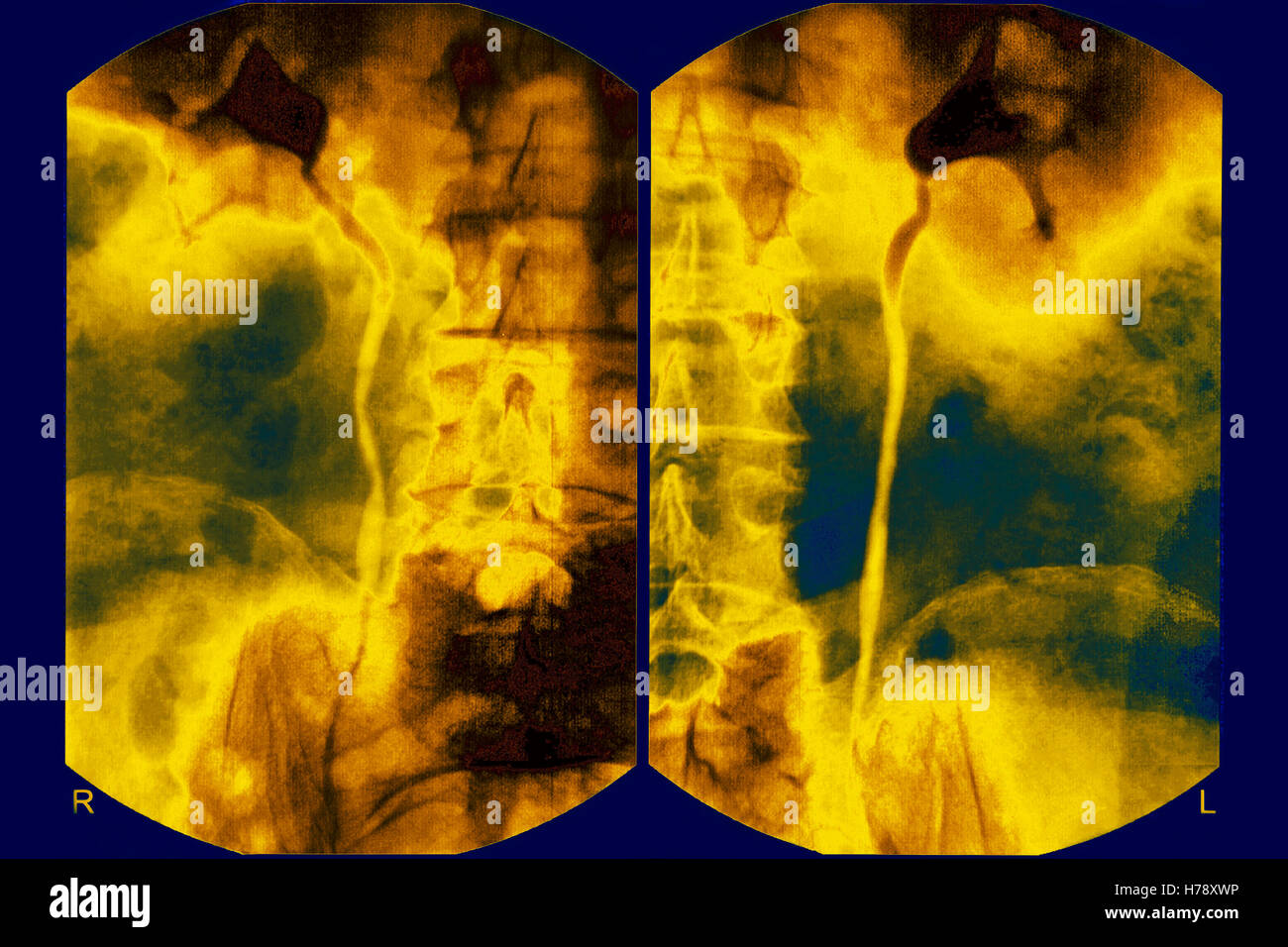 X ray urinary system normal hi-res stock photography and images - Alamy