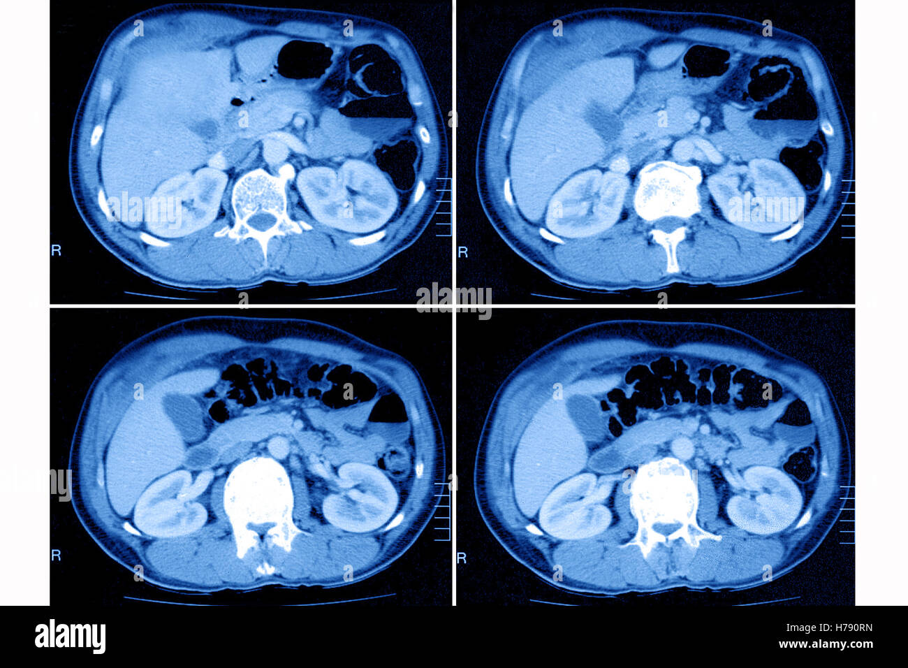 Ct Scan Abdomen High Resolution Stock Photography and Images - Alamy