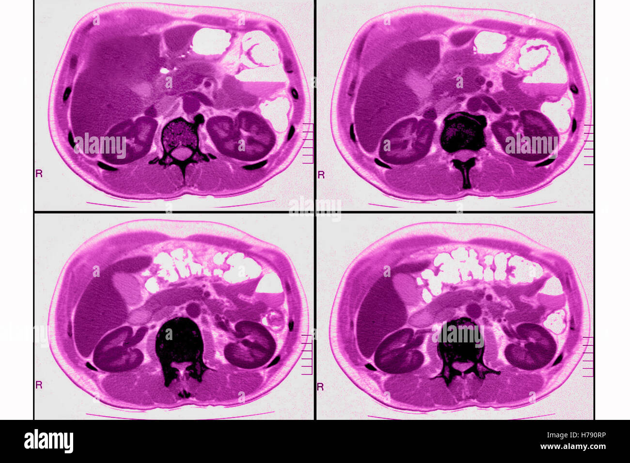 Normal liver scan hi-res stock photography and images - Alamy