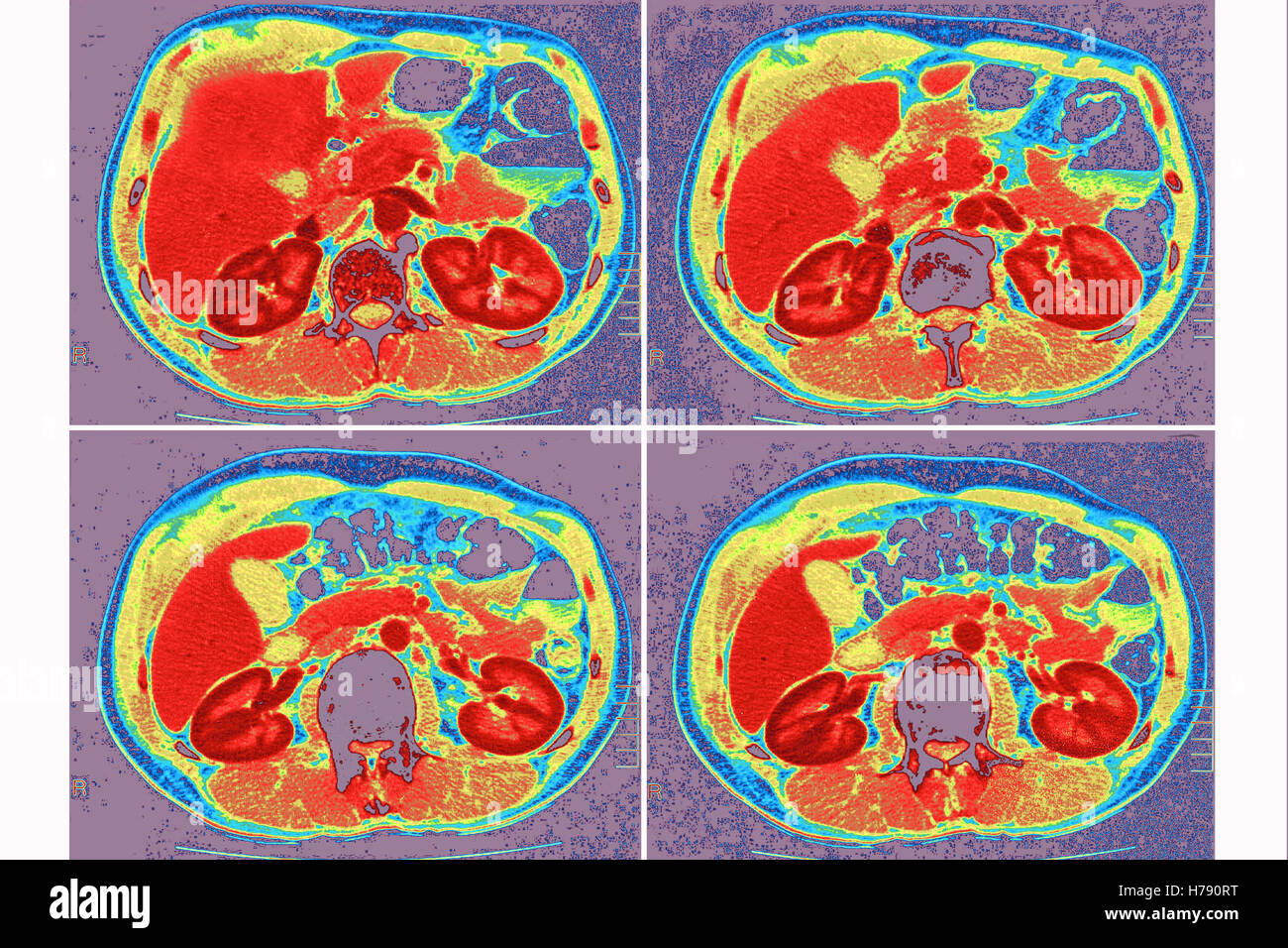 Ct Scan Abdomen High Resolution Stock Photography and Images - Alamy