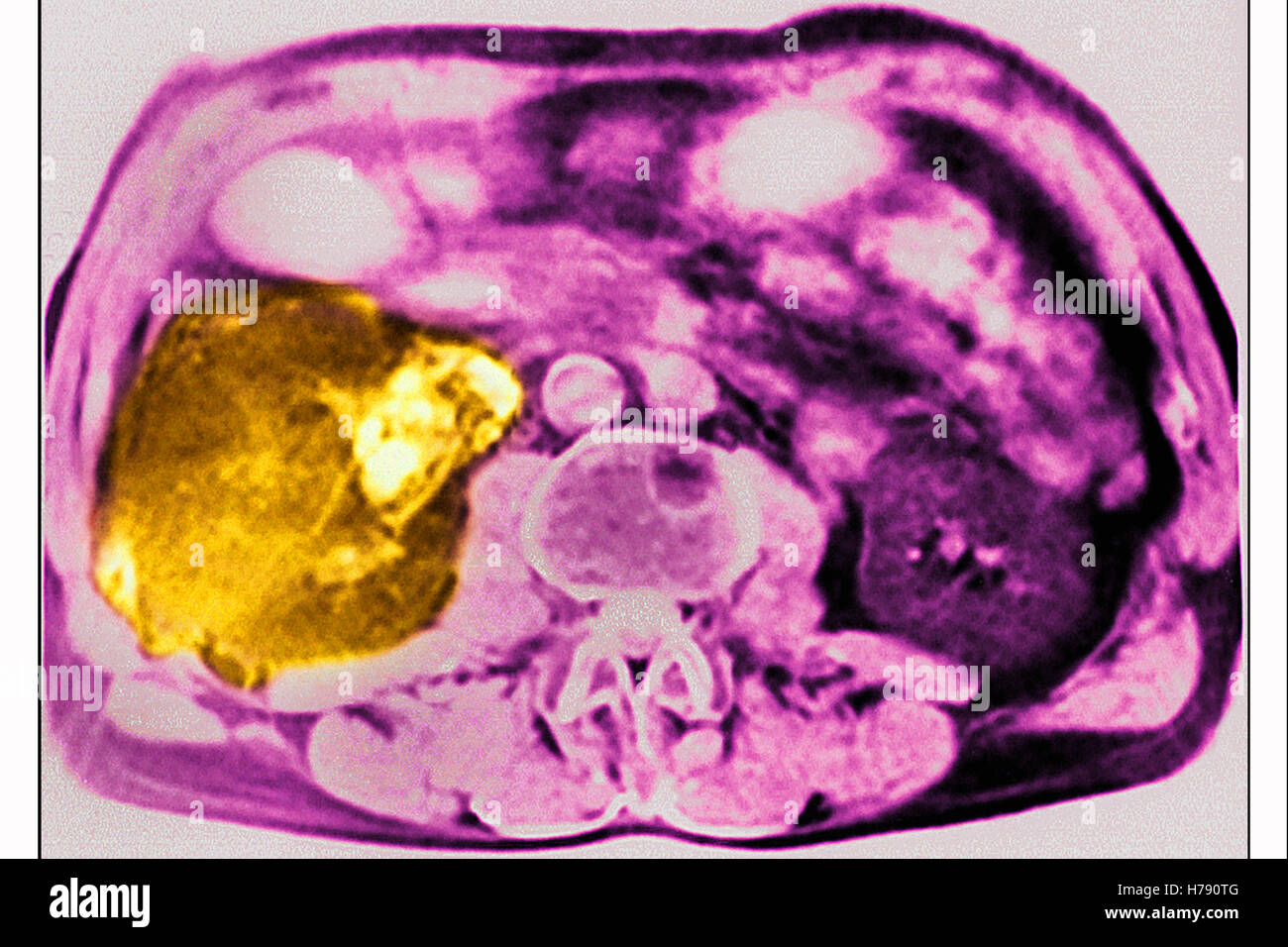 Liver cancer hi-res stock photography and images - Alamy