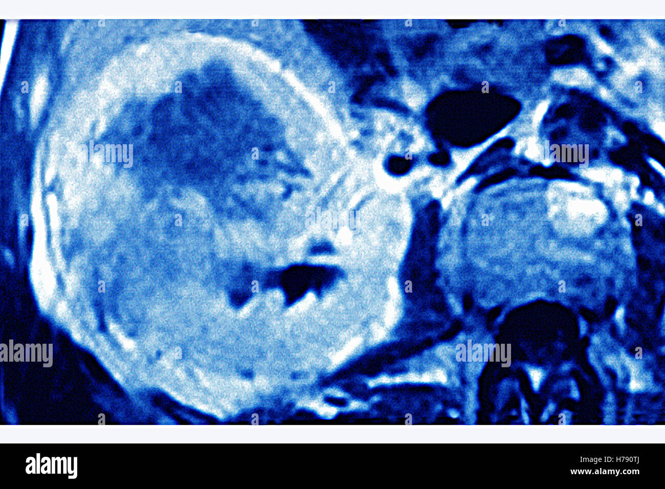 Liver cancer hi-res stock photography and images - Alamy