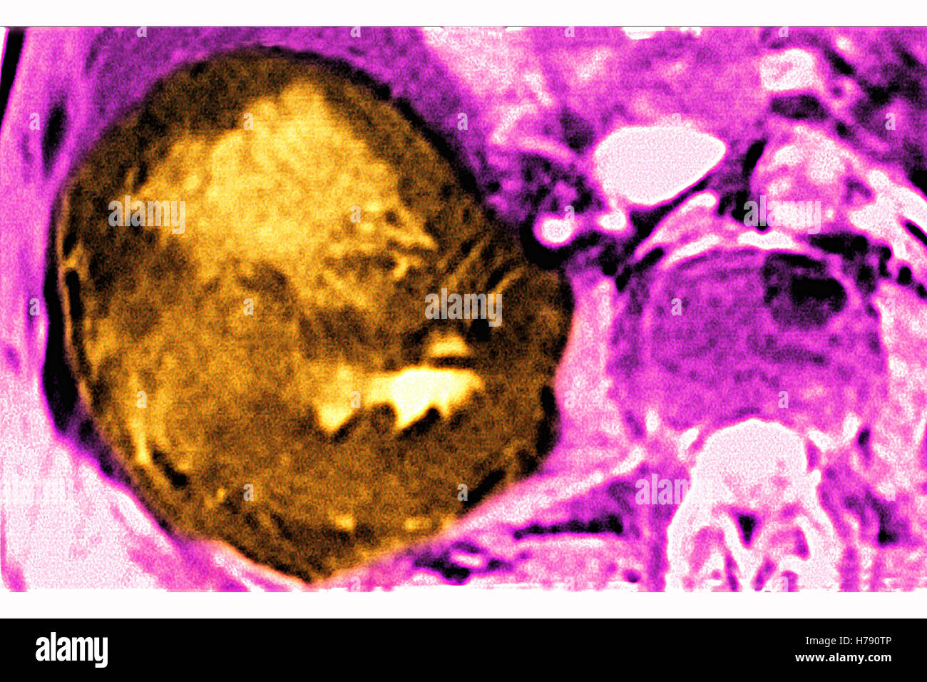 LIVER CANCER, SCAN Stock Photo - Alamy