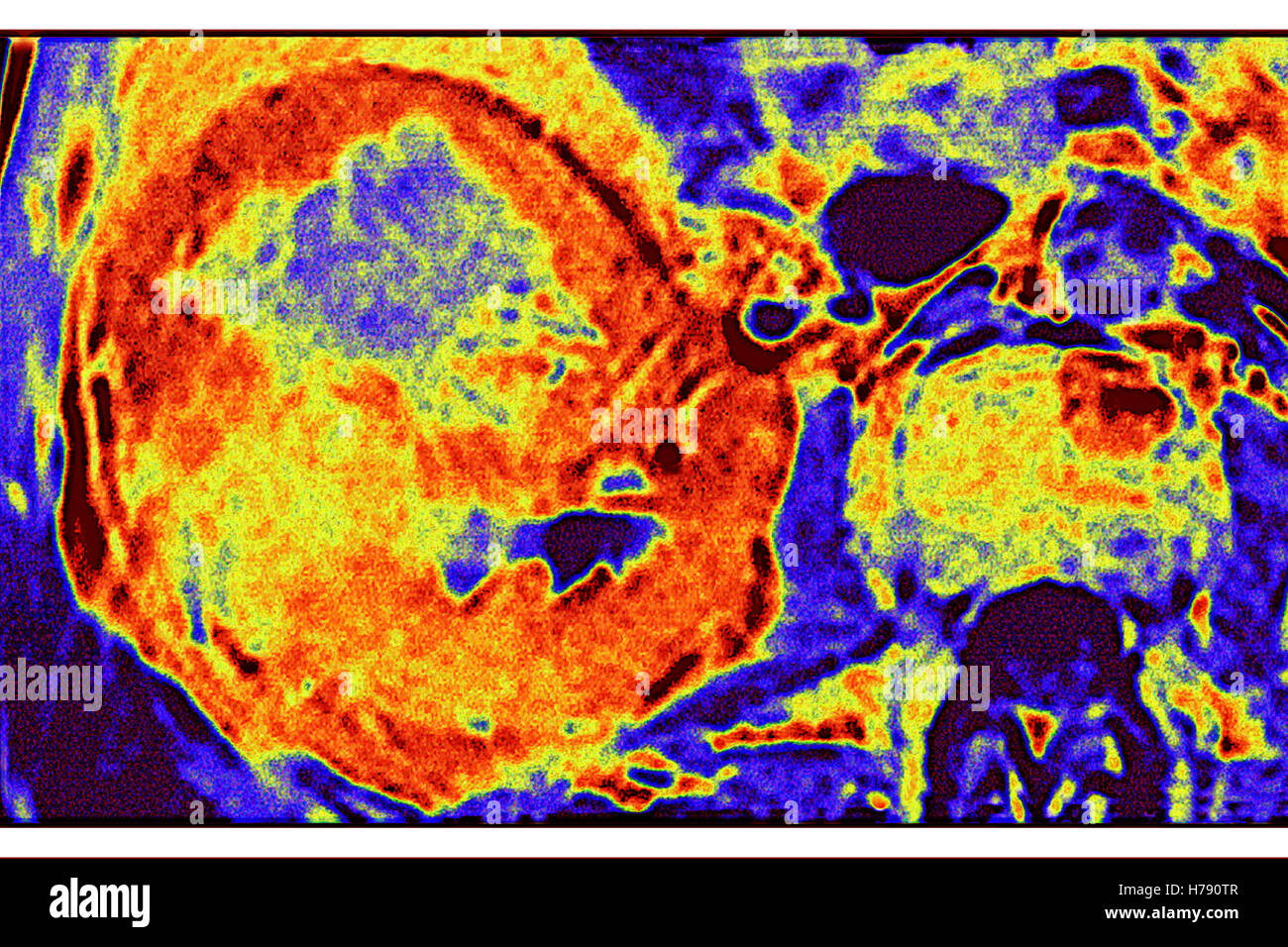 LIVER CANCER, SCAN Stock Photo - Alamy