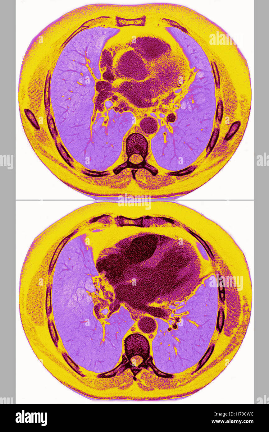 Cardiac Mri High Resolution Stock Photography and Images - Alamy