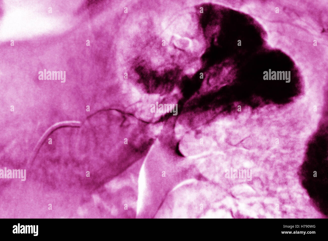 Renal infarction hi-res stock photography and images - Alamy