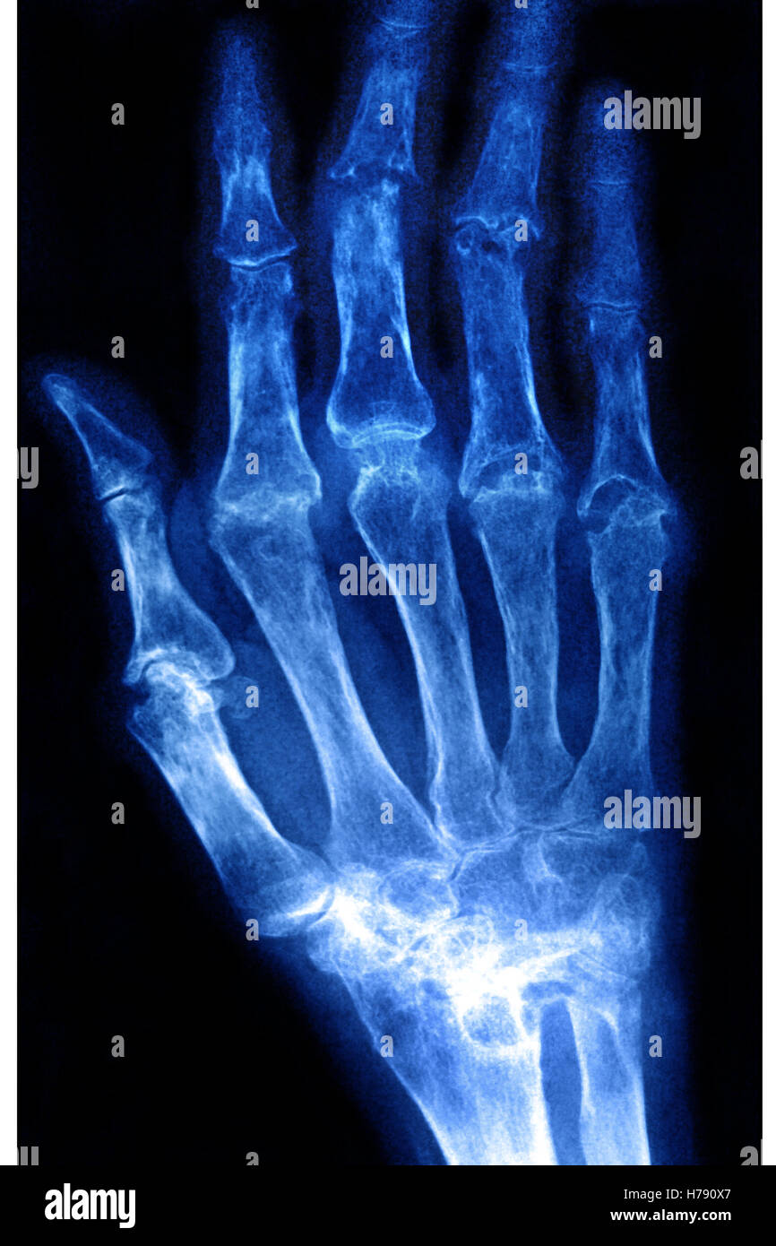 RHEUMATOID ARTHRITIS, X-RAY Stock Photo - Alamy