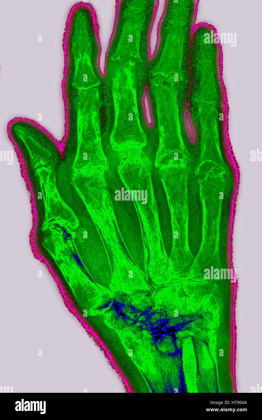 X ray hands arthritis hi-res stock photography and images - Alamy